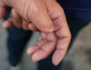 What You Need to Know About Hand Nerve Injury Treatments | IHTSC