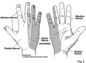 Cubital Tunnel Syndrome | Patient Education | IHTSC
