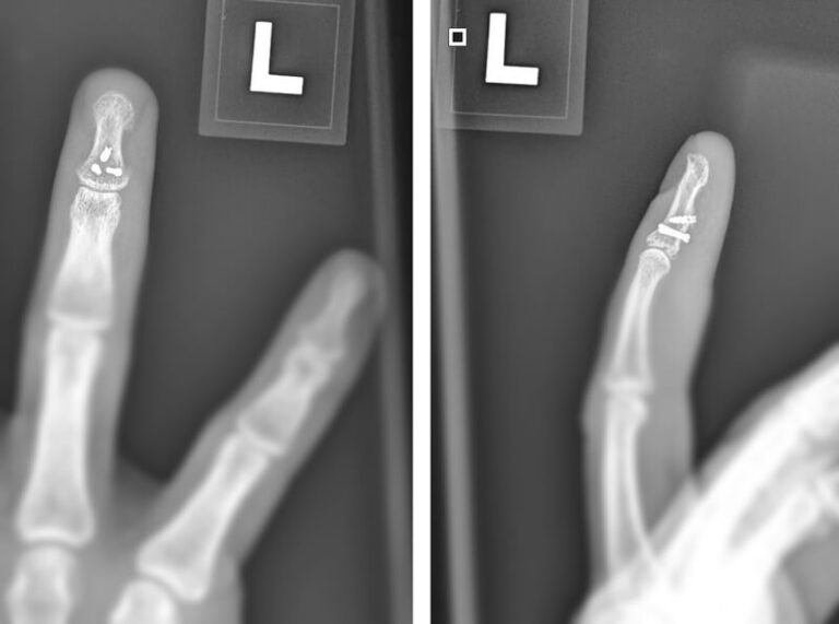 Jersey Finger | Hand Surgery | IHTSC