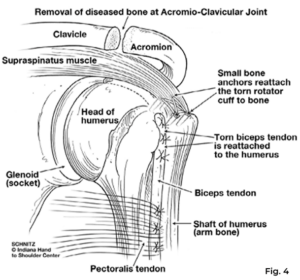 Shoulder Impingement | Patient Education | IHTSC