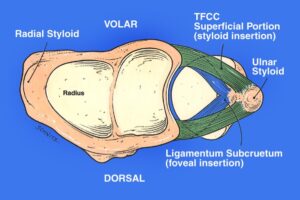 TFCC Tear | Wrist Injury | Indiana Hand to Shoulder Center