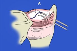 TFCC Tear | Wrist Injury | Indiana Hand to Shoulder Center